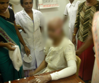 Lifelong Struggles Of Burn Victims - Do They Get Support?